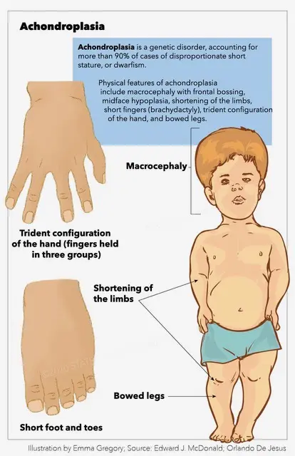 Achondroplasia Ultralydfunn Prenatal Diagnosis, Management And